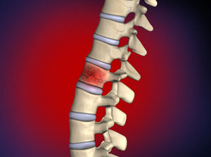 Vertebral Compression Fracture – Nevada Pain Care